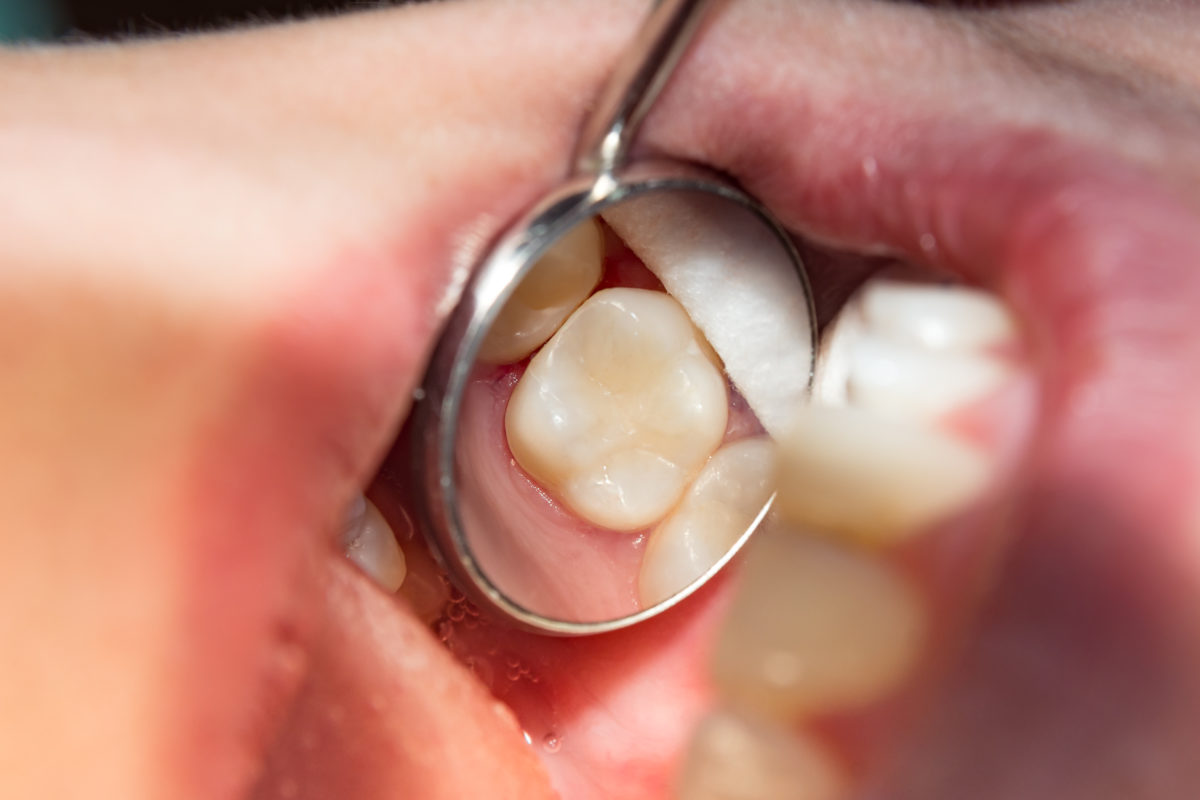 How Much Does Cavity Filling Cost North York Dental Clinic